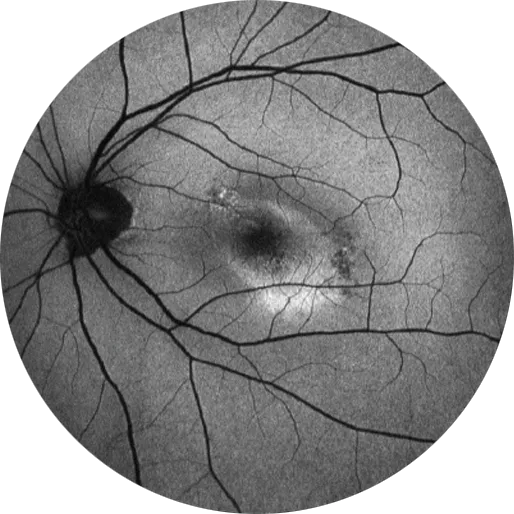 Retinal Camera